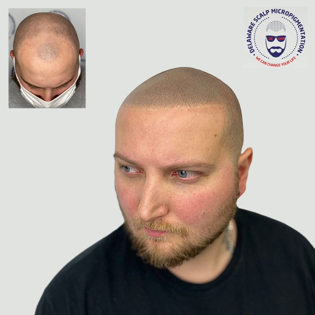What Is a Hairline Tattoo? SMP Explained