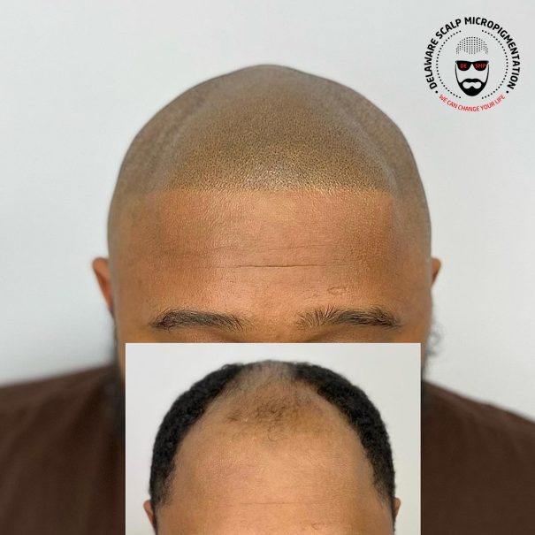 Mystery: What Causes an Uneven Hairline and How to Fix It